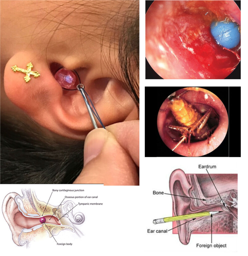 Ear Wax | Sri Onkar Eye & ENT Care Centre
